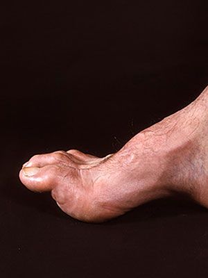 Top 3 Common Foot Problems - happy-hospitals