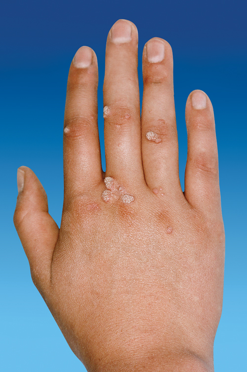 Como Se Quitan Las Verrugas - 6 Remedios Para Eliminar Verrugas - Como ...