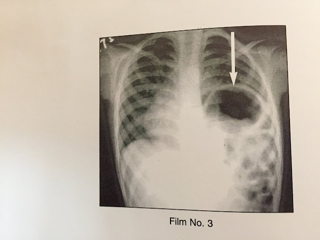 XRAYS OF EVENTRATION