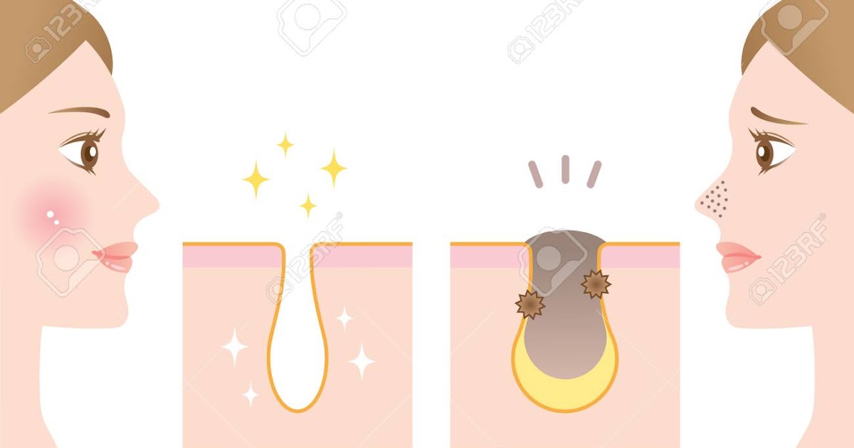 why do we have clogged pores?