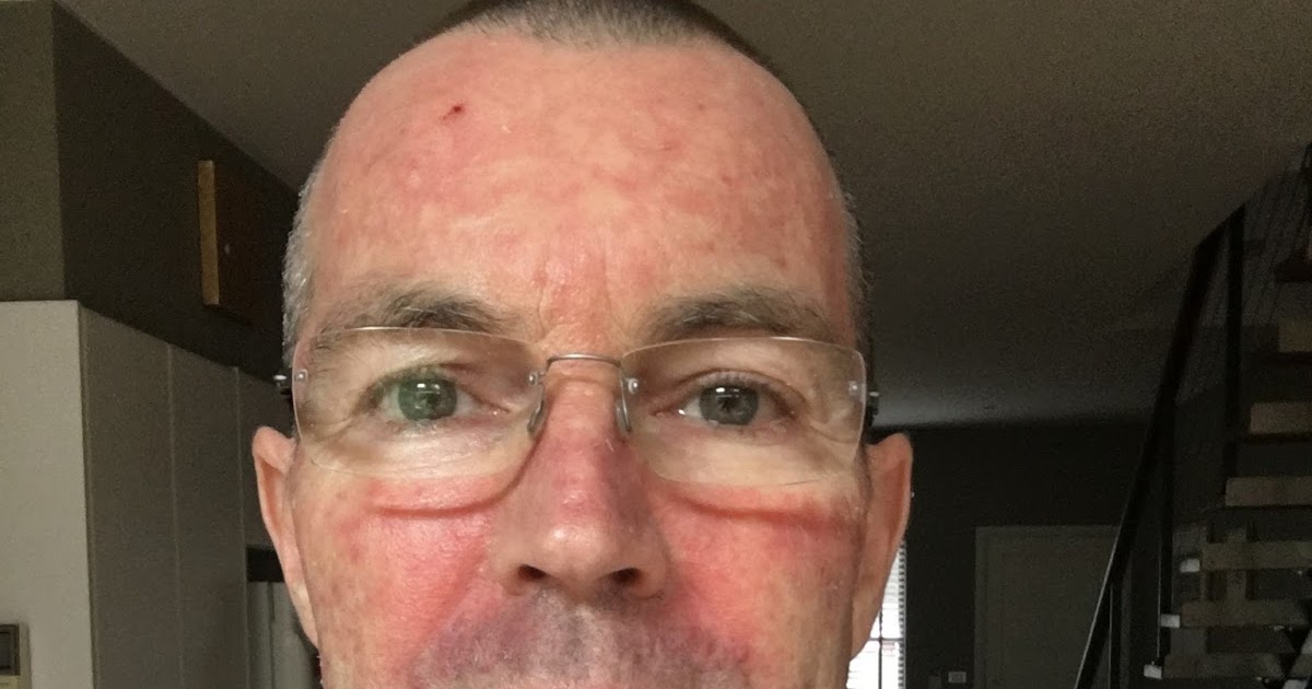 Efudix Treatment: Day 28 - Post day 9