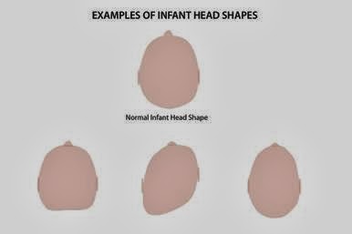 My Little Head: 10 Flat Head Syndrome Facts!!