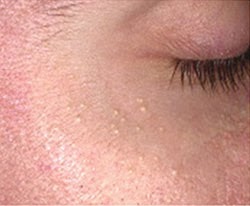 Milia : What is Milia ? | MILIA REMOVAL