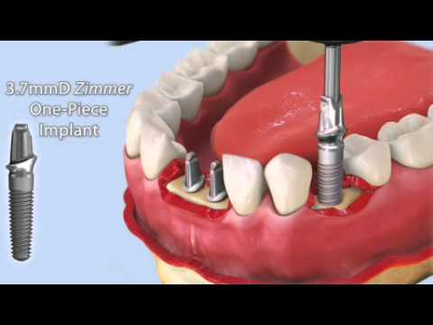 Control YourSelf: Zimmer One Piece Implant