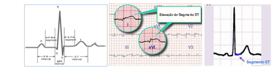 Diagnóstico de IAM sin elevación del segmento ST