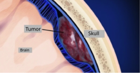 How to Treat a Skull Tumor in an Effective Way