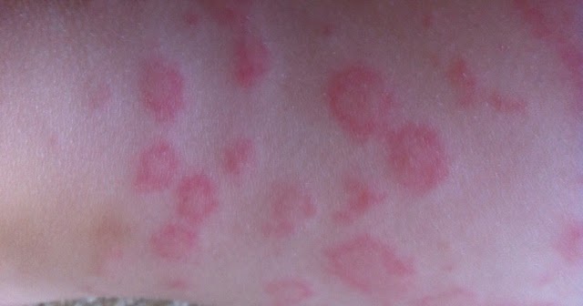 Baby, Borneo or Bust. . .: And Now, Fun With Amoxicillin Allergy!