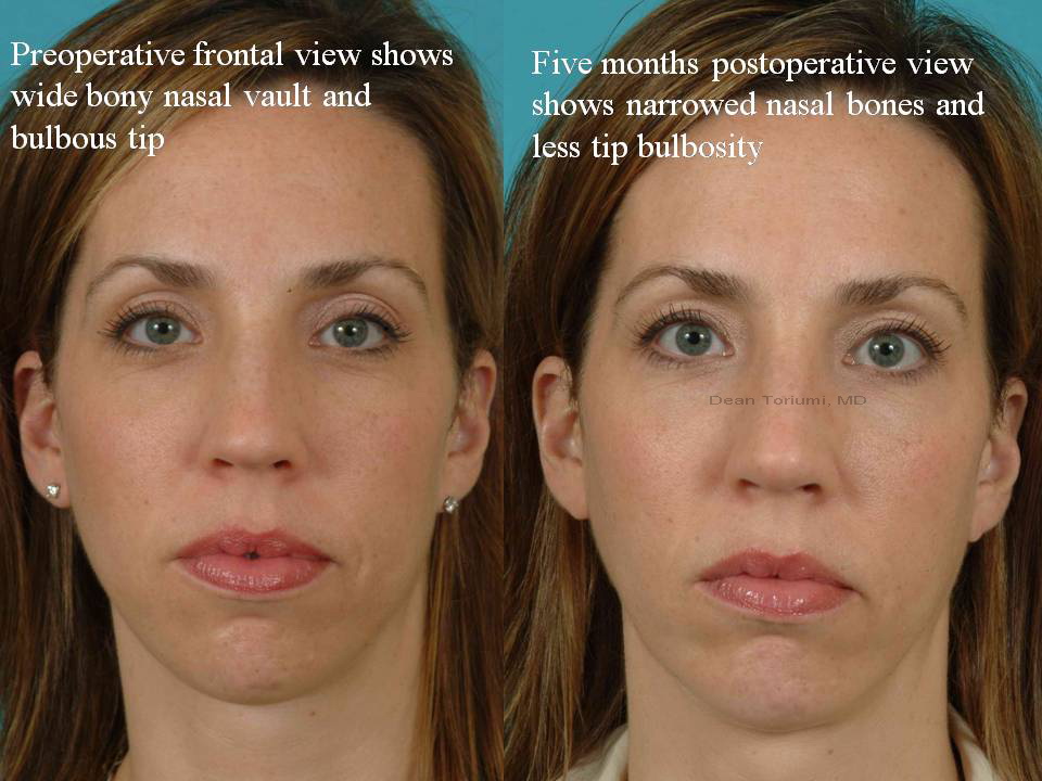 Dr. Dean Toriumi Reviews: Dean Toriumi Reviews: Patient presented with ...