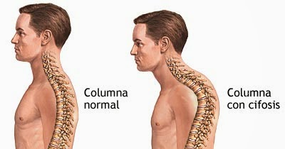 Enfermedades crónicas: Cifosis
