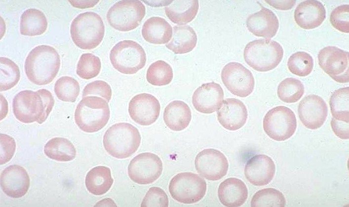 Hematología: Anormalidades Eritrocitarias
