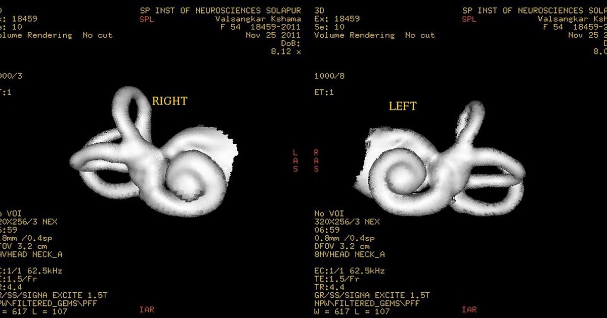 Neuroradiology Cases: MRI 3D Inner Ear