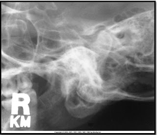 Royal Glamour Radiologi: Temporo Mandibular Joint (TMJ)