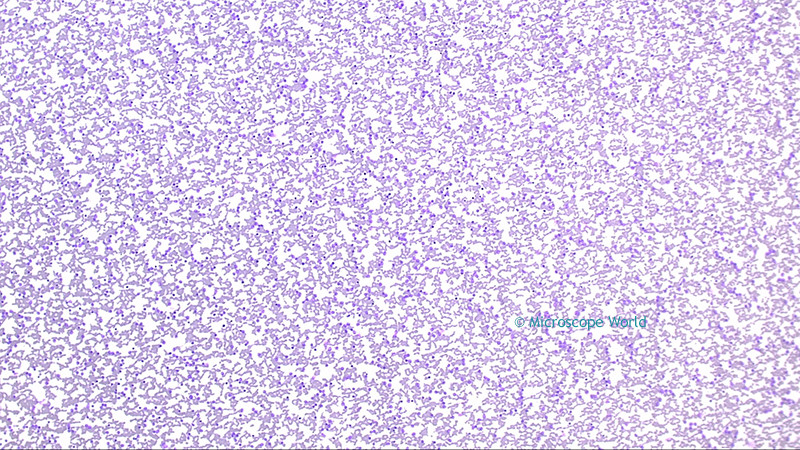 Microscope World Blog: Leukemia Under the Microscope