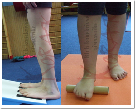 Ravno stopalo: Terapija i vezbe ravnog stopala