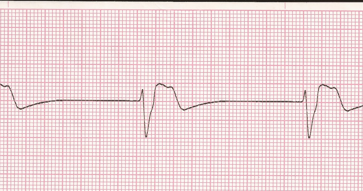 EKG Rhythm Strips: Slow rhythms 3