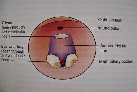 Brain & Mind - A to Z: Role of Endoscopic Third Ventriculostomy ( ETV ...