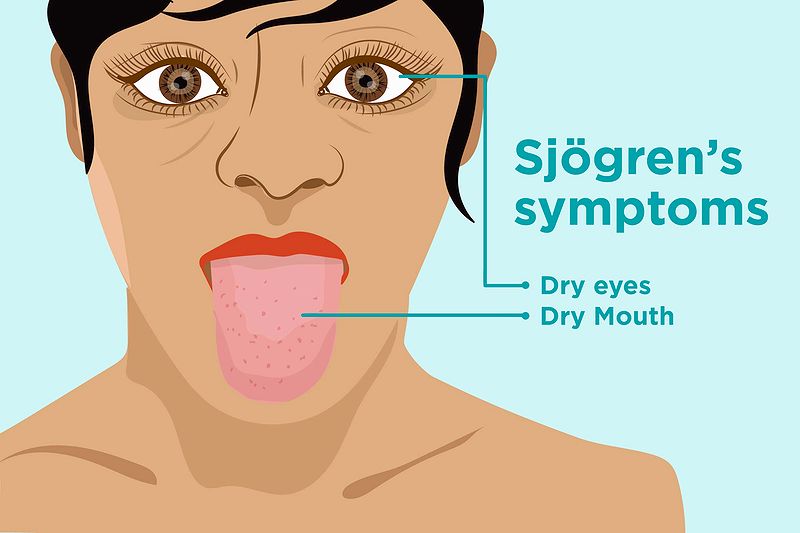 PDF: Diagnostic evaluation of serial sections of labial salivary gland ...