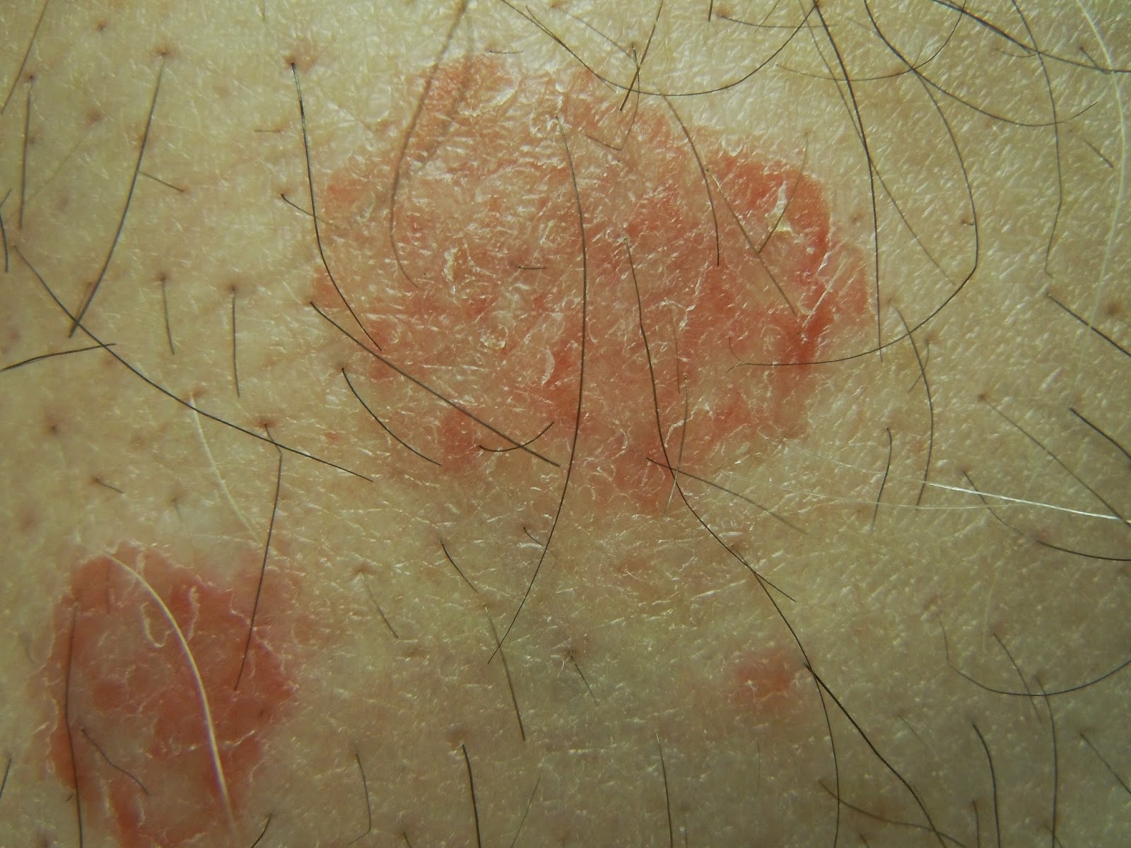 SKIN DISEASE TYPES: Nummular Dermatitis