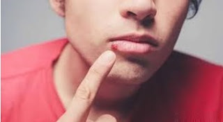 Sapinho Na Boca - Como Cuidar Desses Indesejáveis Fungos? - Saúde ...