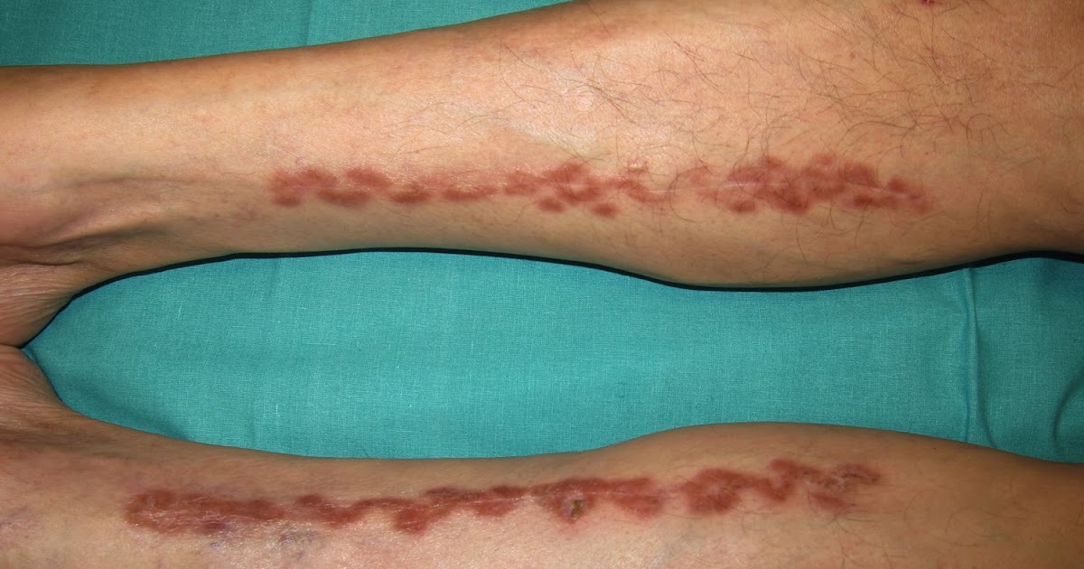 Dermapixel: Cicatrices extrañas