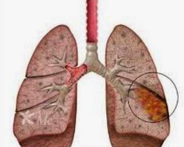 Penyebab Infeksi Paru Paru dan Pengobatannya | Manfaat Daun Sirsak