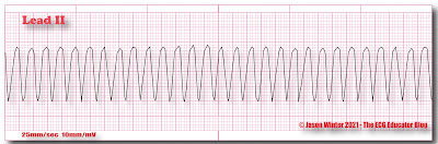 ECG Educator Blog : Ventricular Flutter
