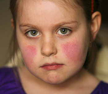 Slapped Cheek Disease