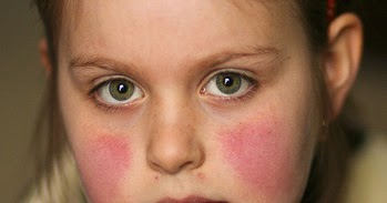 Slapped Cheek Disease