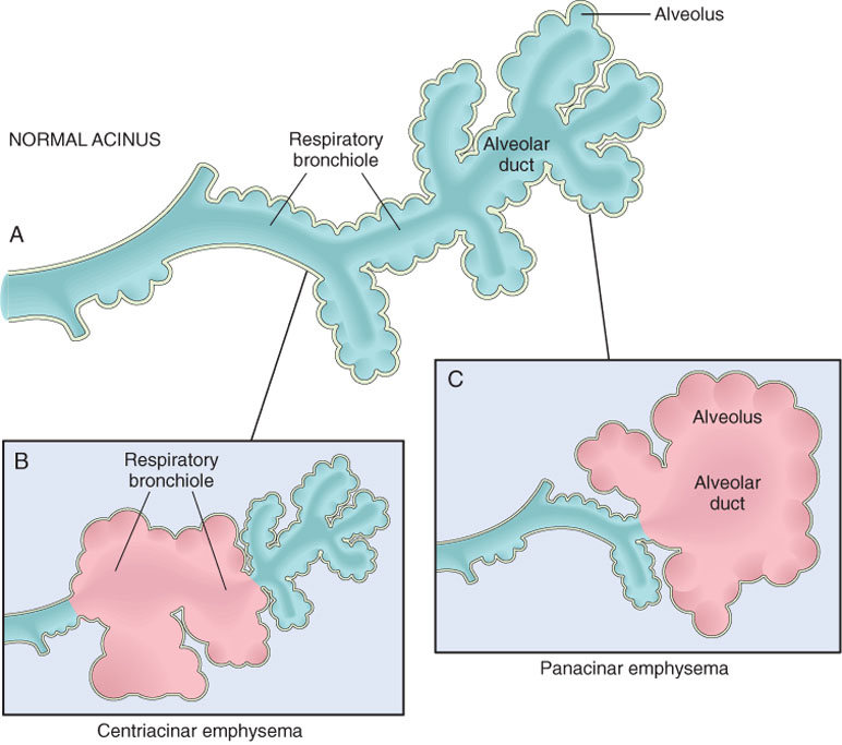 Emphysema ~ Medicine Hack