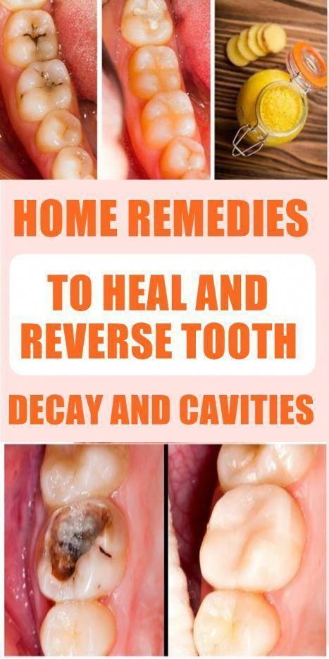 How To Reverse Natural Tooth Decay And Remineralize Teeth At Home ...