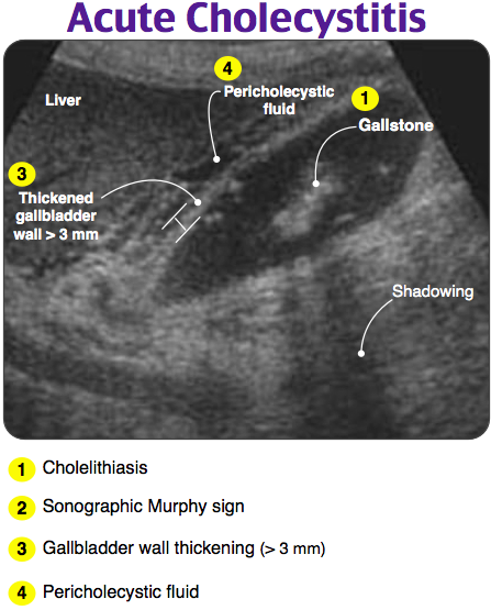 MEDICAL ULTRASOUND/ACUTE AND CHRONIC CHOLECYSTITIS