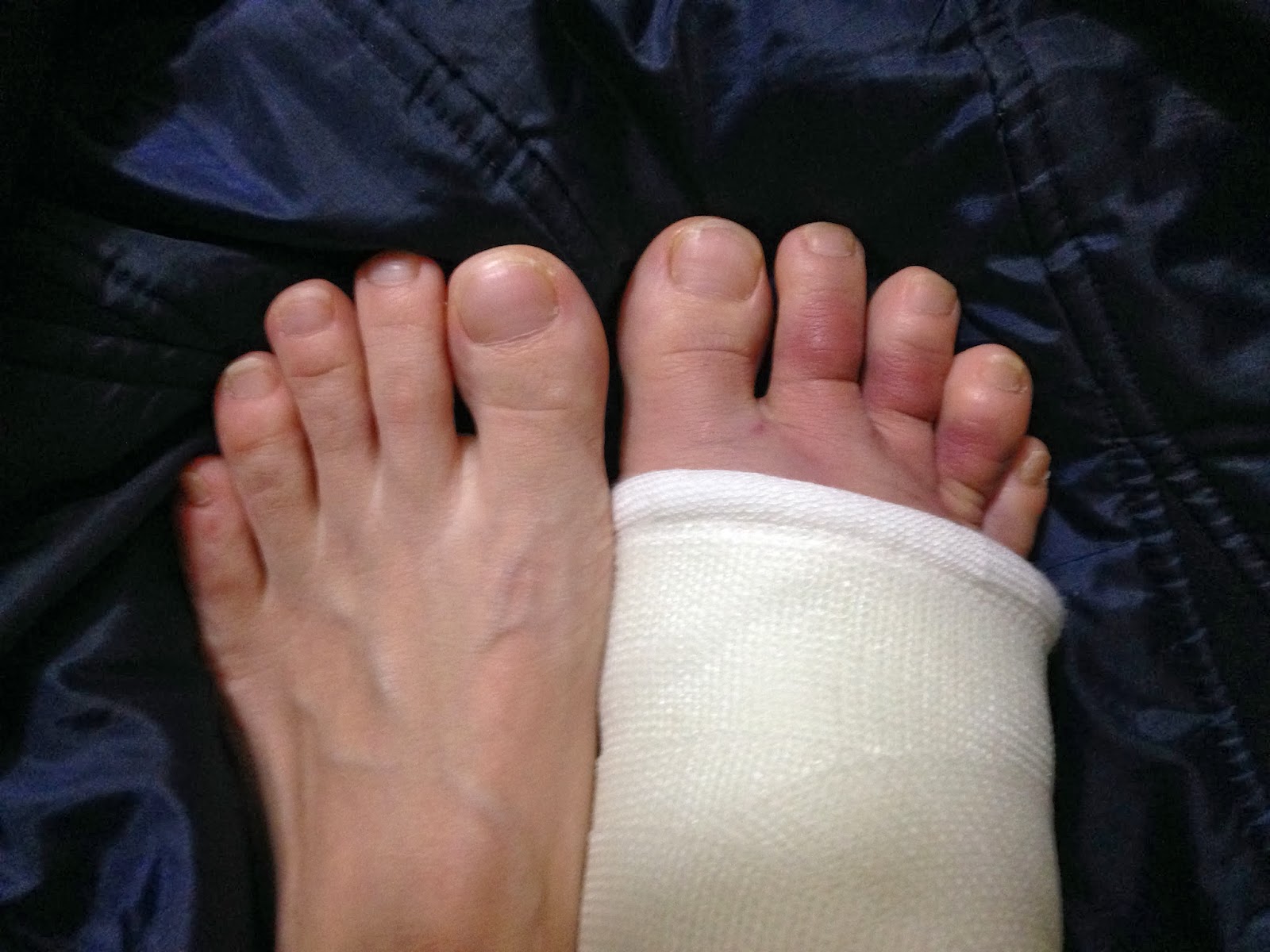 右腳掌骨裂 Right Foot Injury With Fracture: 拗柴第三天 Day 3 after injuried
