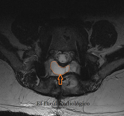 El Baúl Radiológico: SEROMAS POSTQUIRÚRGICOS PARAVERTEBRALES (Lumbar ...