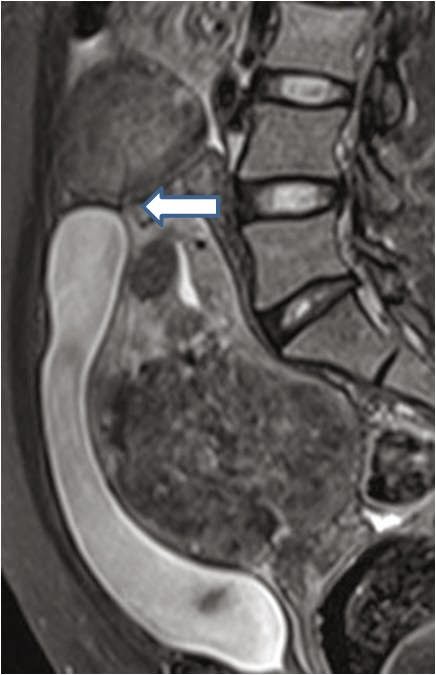 RADIODIAGNOSIS - IMAGE COLLECTION: PEDUNCULATED SUBSEROSAL FIBROID