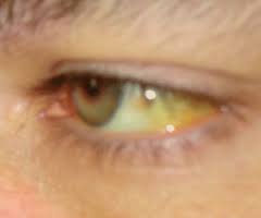 penyakit mata kuning