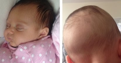 Hair Loss Treatment, Causes, Home Remedies & Prevention: Why Do Babies ...