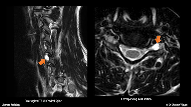 Ultimate Radiology : Perineural cysts (Tarlov cysts) of the cervical spine