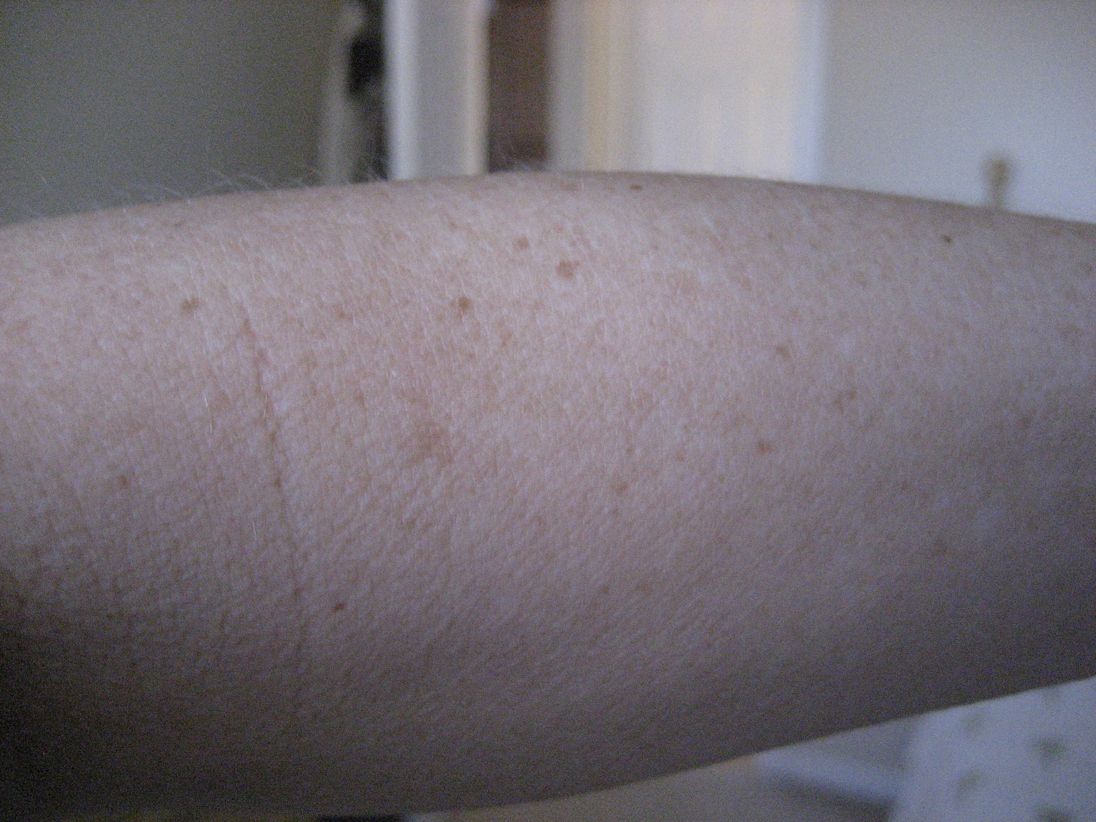 Chemical Peels For Acne And Anti Aging 25 Tca Peel For Arms Day 15