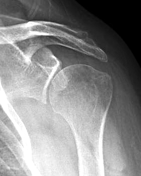 UW Shoulder and Elbow Academy: Shoulder injection led to shoulder infection