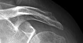UW Shoulder and Elbow Academy: Shoulder injection led to shoulder infection