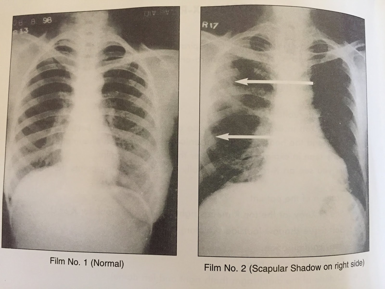 NORMAL XRAY CHEST