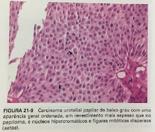Atlas virtual de histologia e patologia: [CC #13]: CARCINOMA UROTELIAL