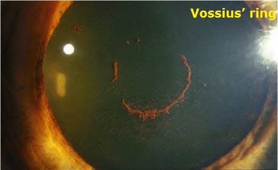 Ophthalmology Notes: SPOTS & DOTS in Ophthalmology
