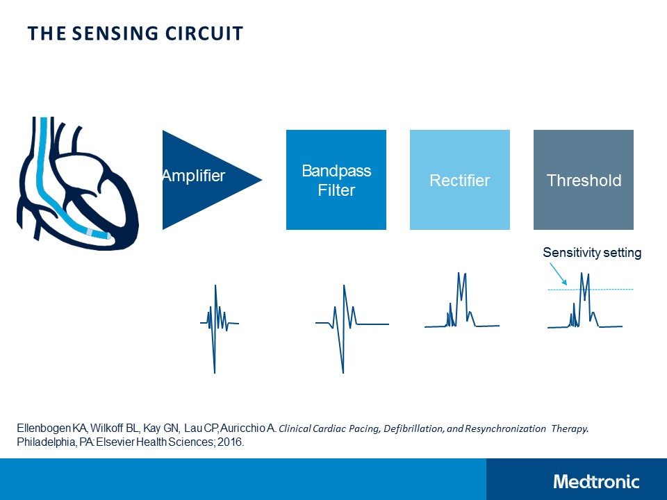 CVT Mohd Farid: Concept Of ICD Technology-Sensing & Detection-Medtronic ...