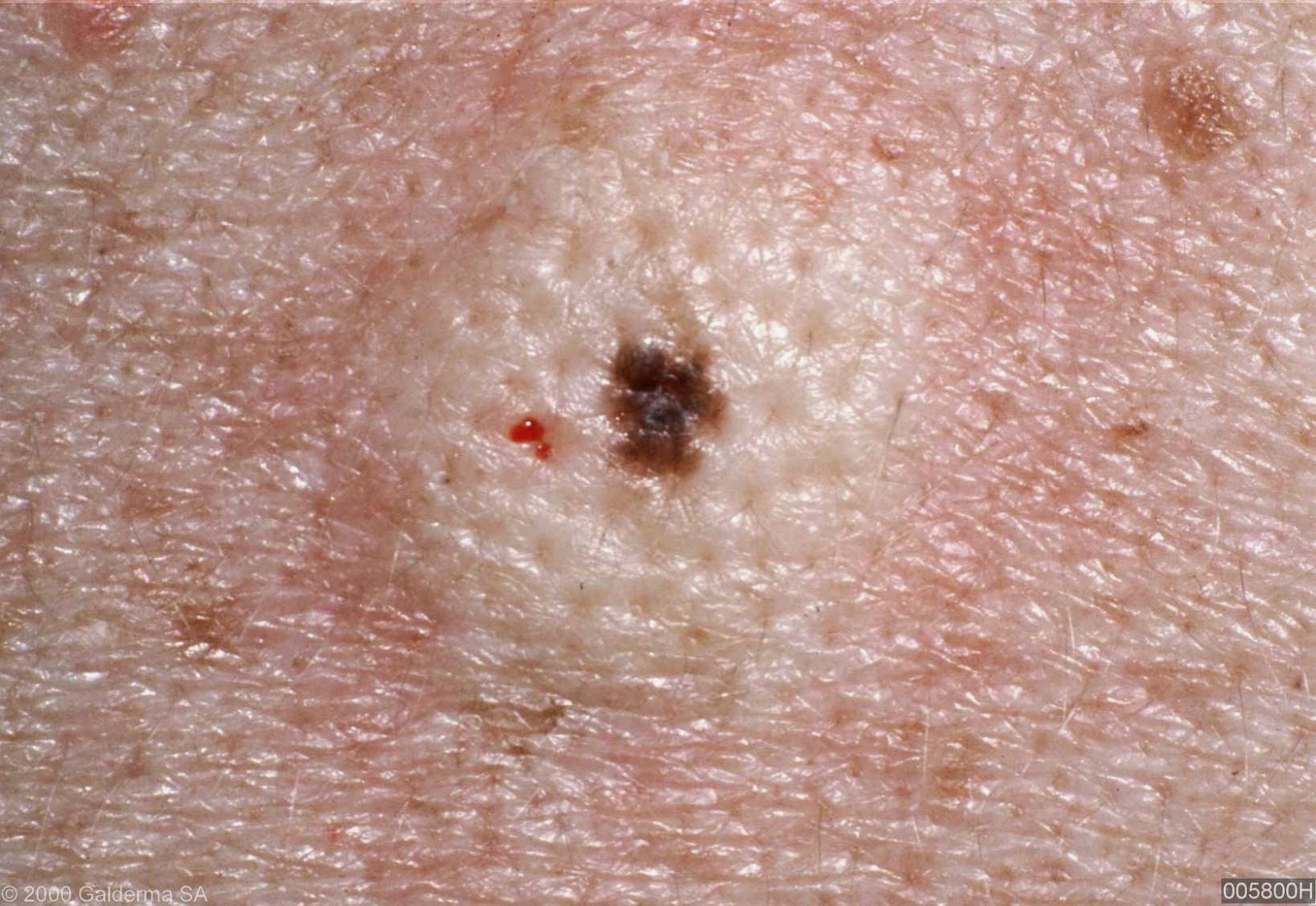 SKIN DISEASE TYPES: Lentigo Simplex (Skin Disease Type)