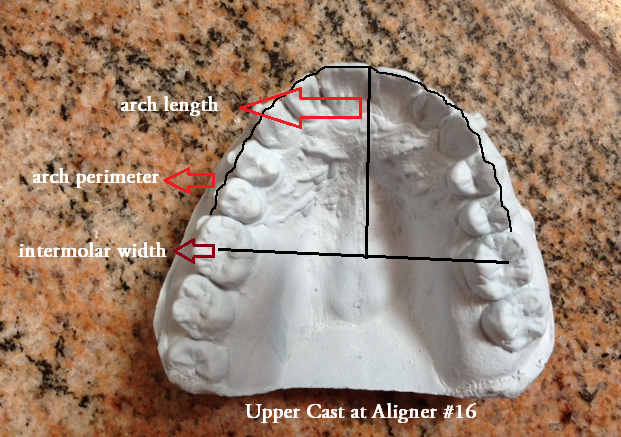 My Journey to LIFE. (previously My Invisalign Diaries): Maths on my ...