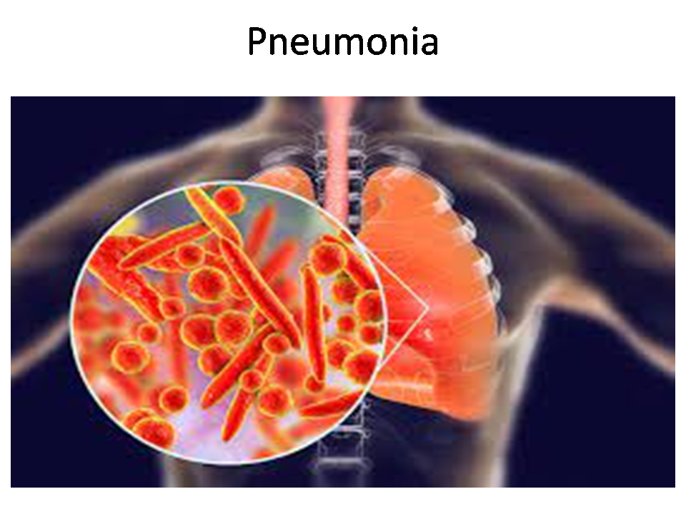 pneumonia