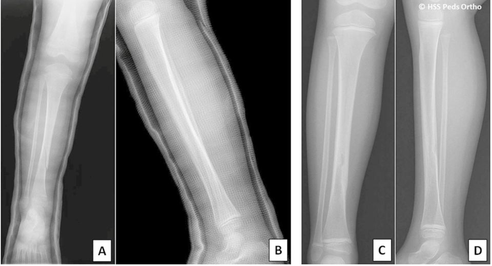 Revisiones_bibliográficas TyO_Web: Fracturas de la diáfisis tibial en ...