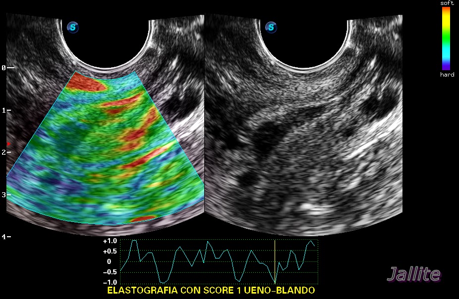 La Cervicometría con Elastografia en la Amenaza de Parto Prematuro
