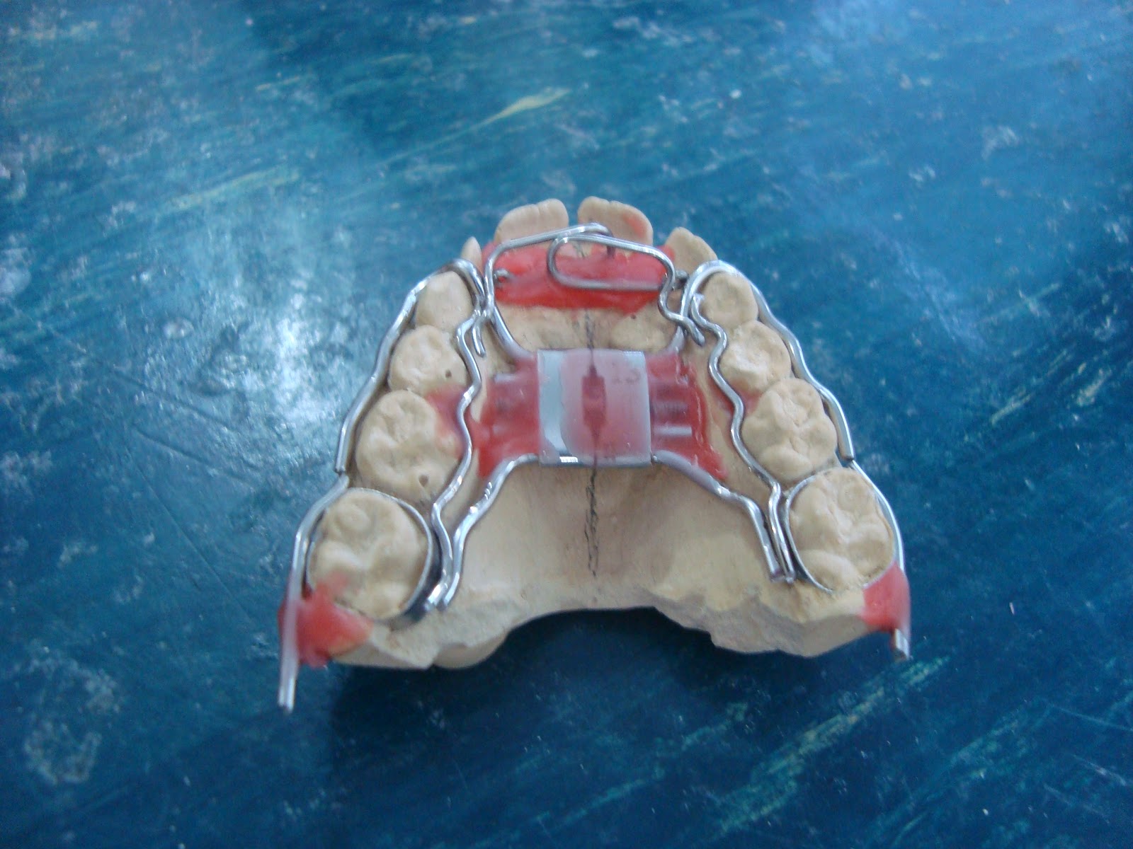 Laboratório Ortodôntico Bohrer: CONFECÇÃO DE HYRAX